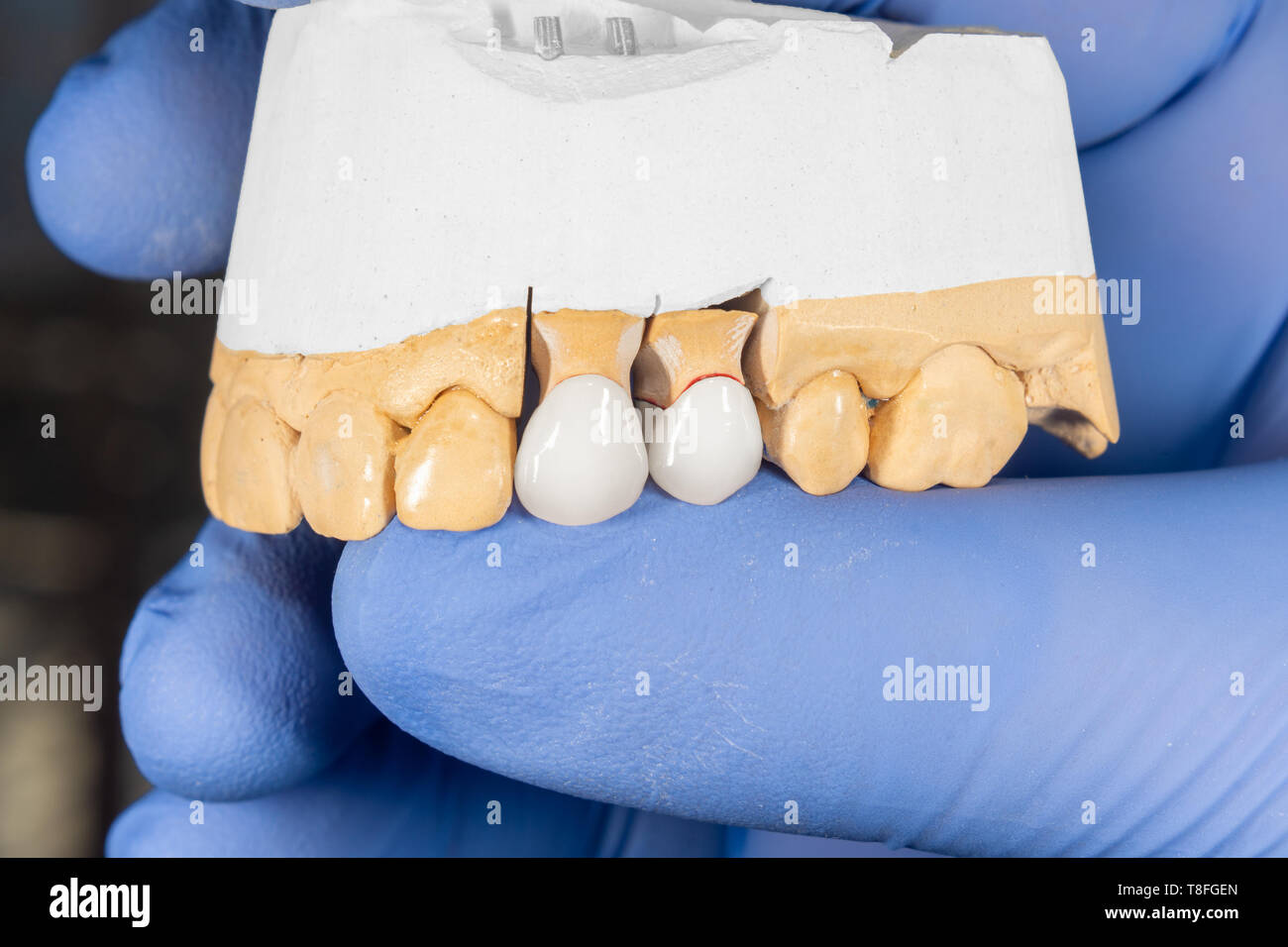 ceramic tooth crown close-up on plaster model. dental prosthesis Stock ...
