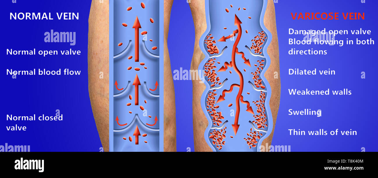 Dvt leg hi-res stock photography and images - Alamy