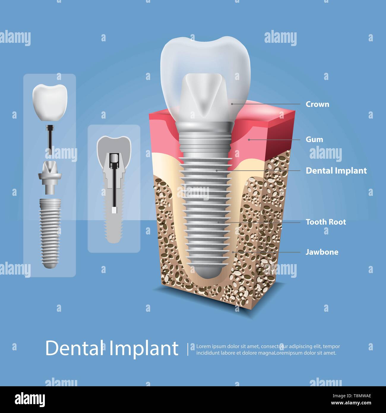 Human teeth and Dental implant Vector Illustration Stock Vector Image ...