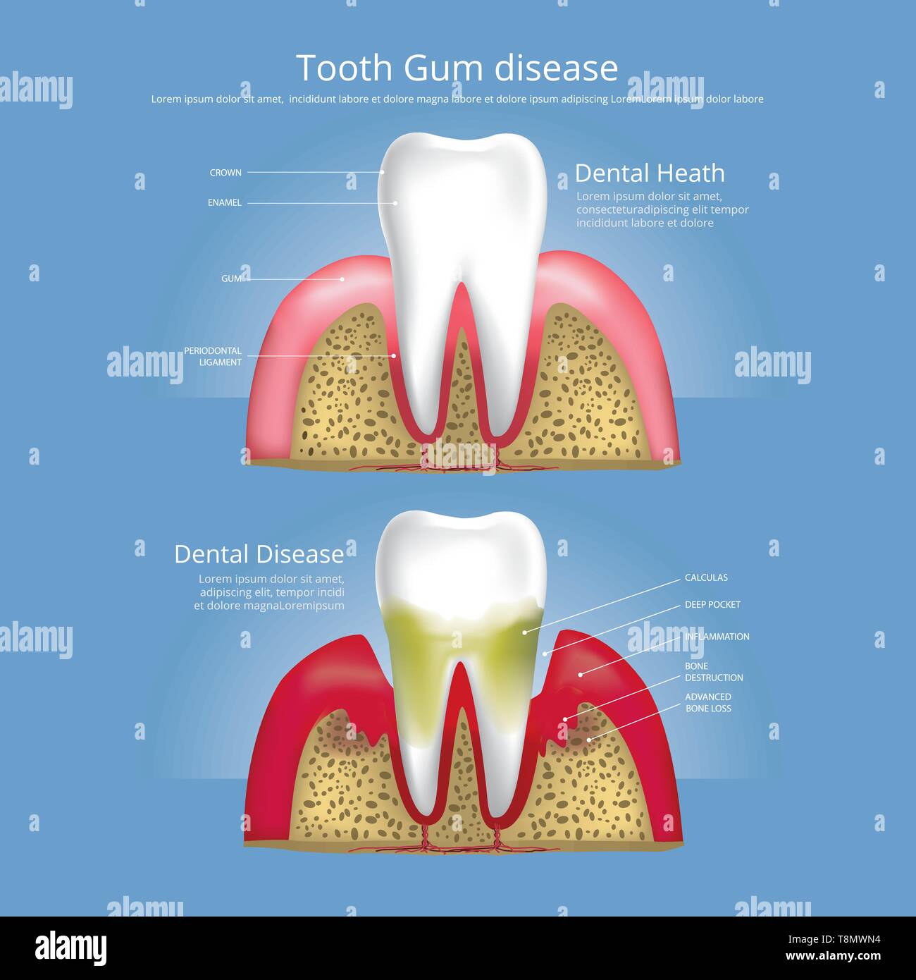 Human teeth Stages of Gum Disease Vector Illustration Stock Vector ...