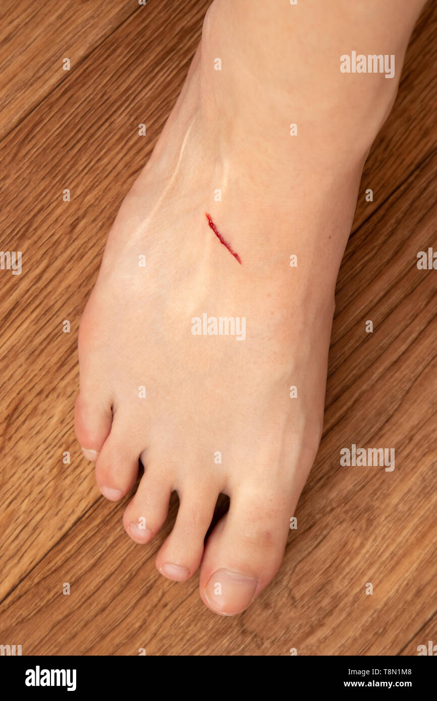 Scab scar hi-res stock photography and images - Alamy