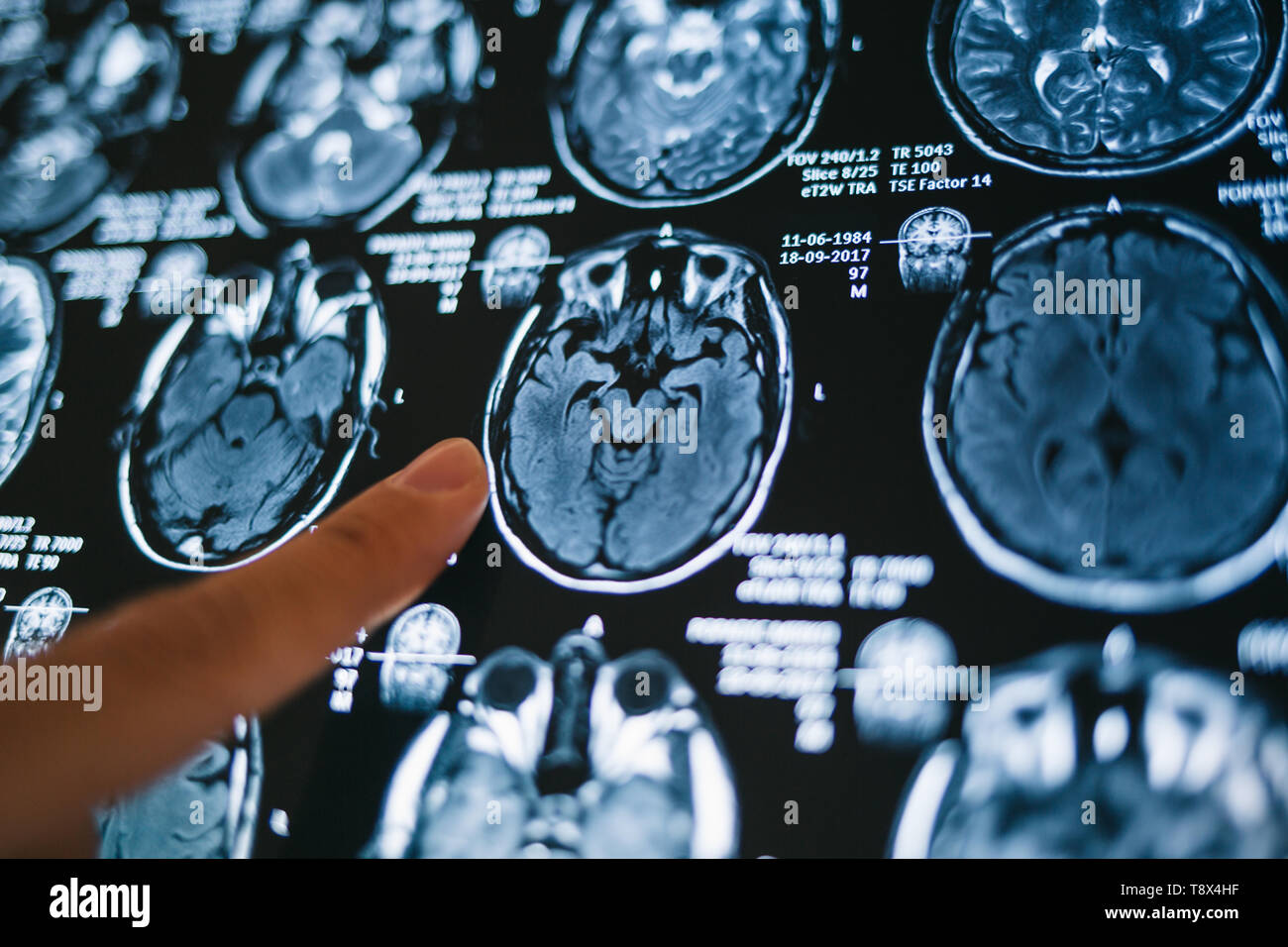 Pointing on magnetic resonance image of brain. MRI head scan. Medicine ...
