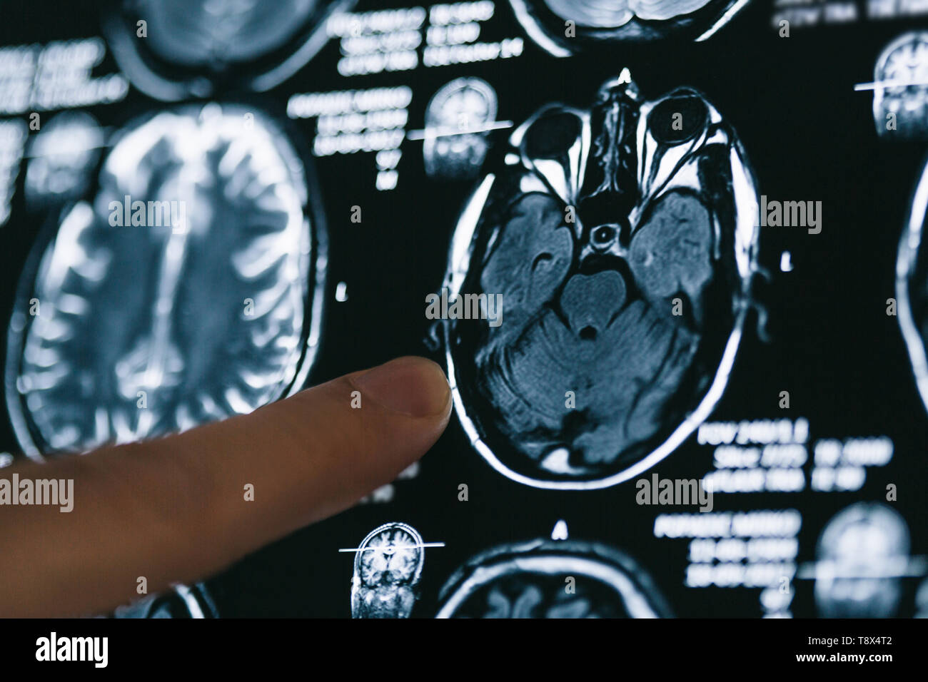 Pointing on magnetic resonance image of brain. MRI head scan. Medicine ...