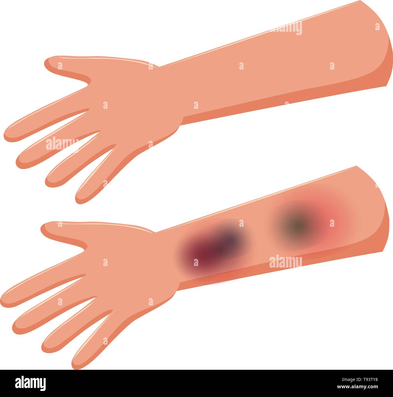 Bruise on hand Stock Vector Images - Alamy
