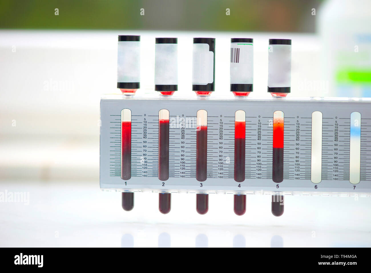 Erythrocyte sedimentation rate test in laboratory Stock Photo - Alamy