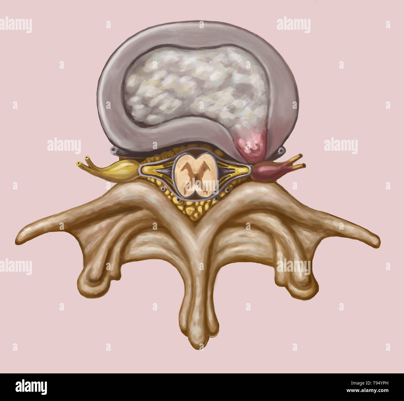 An illustration of the herniation of an intervertebral disk in the ...
