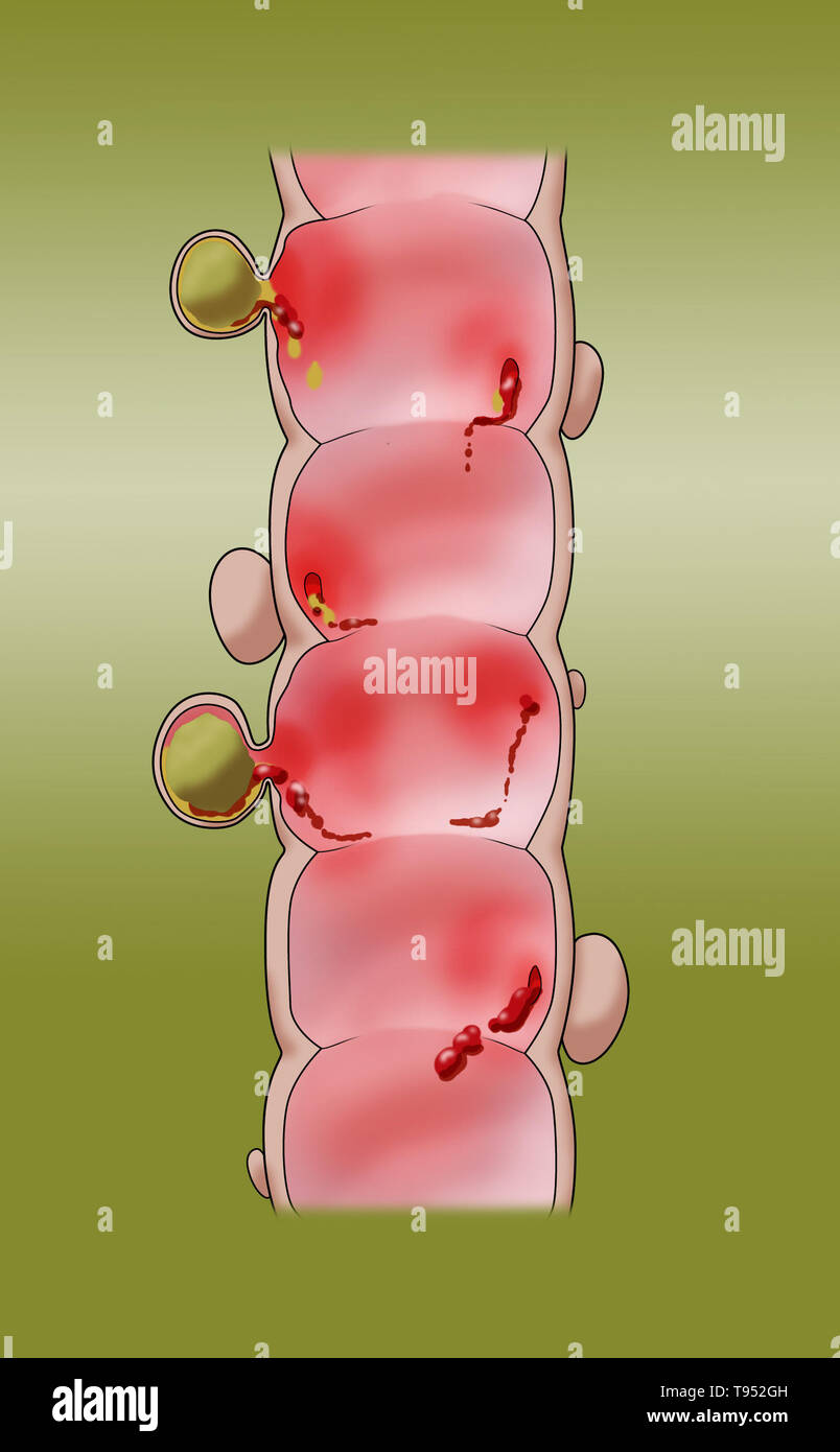 Diverticulitis intestinal hi-res stock photography and images - Alamy