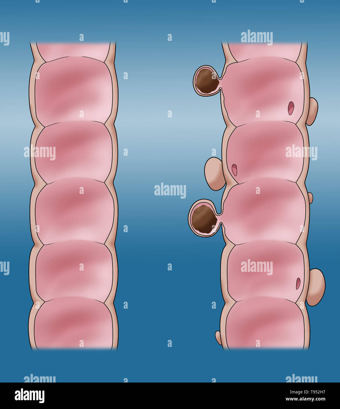 Illustration comparing the appearance of a healthy colon (right) to one ...