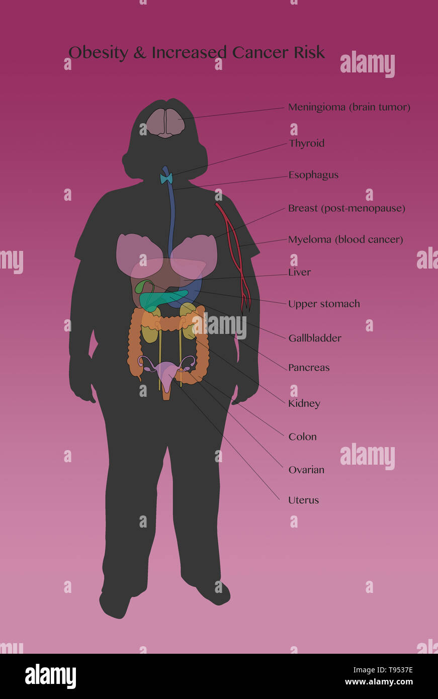 An illustration showing the cancer risks of obesity Stock Photo - Alamy