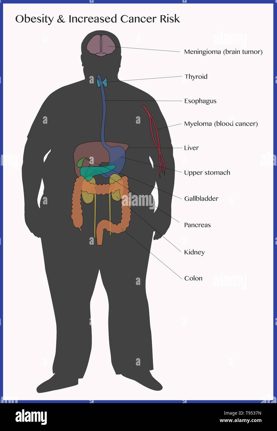 An illustration showing the cancer risks of obesity Stock Photo - Alamy