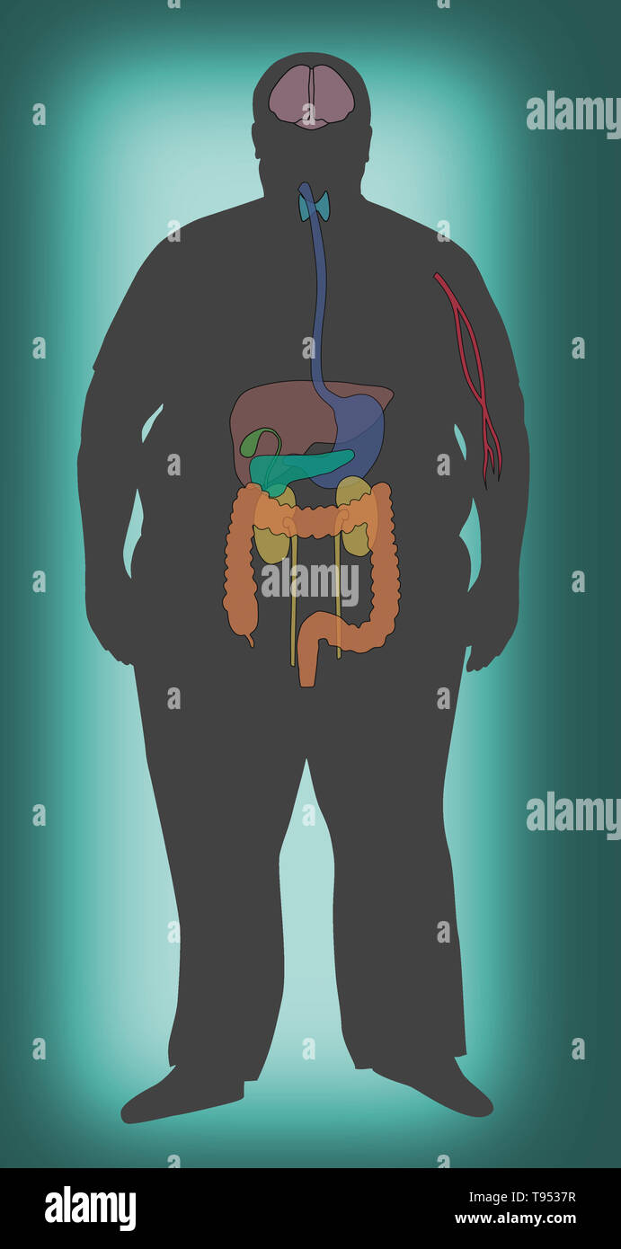 An illustration showing the cancer risks of obesity Stock Photo - Alamy
