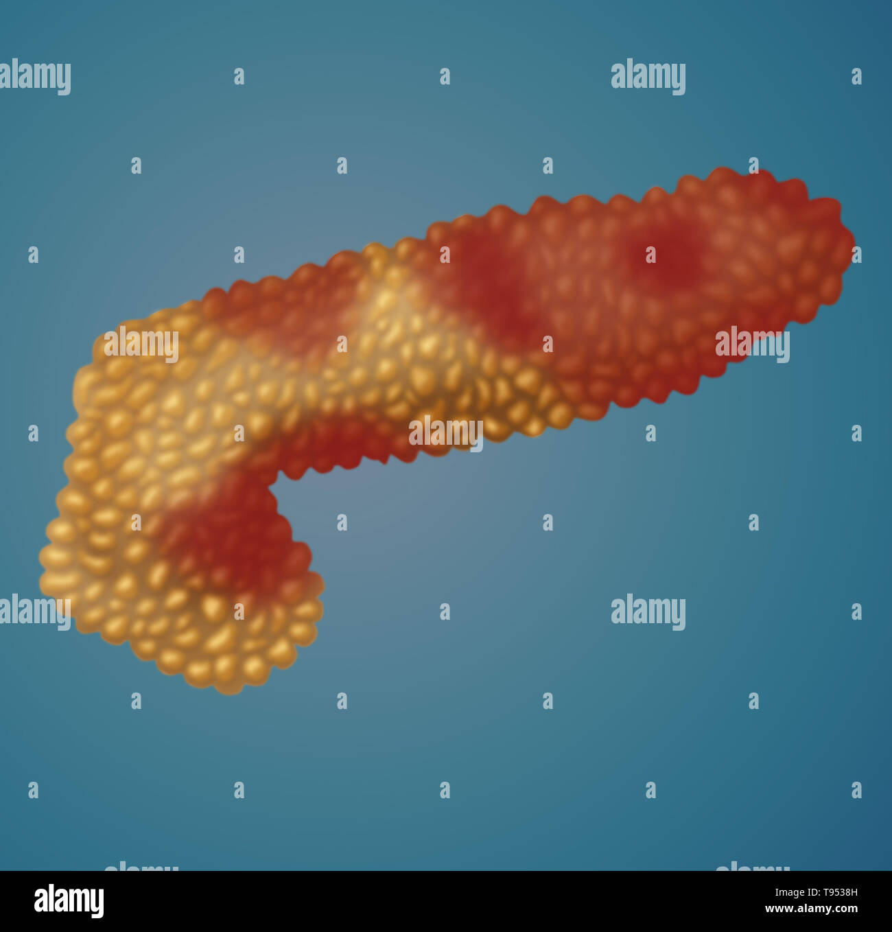 An illustration showing a pancreas with acute pancreatitis ...
