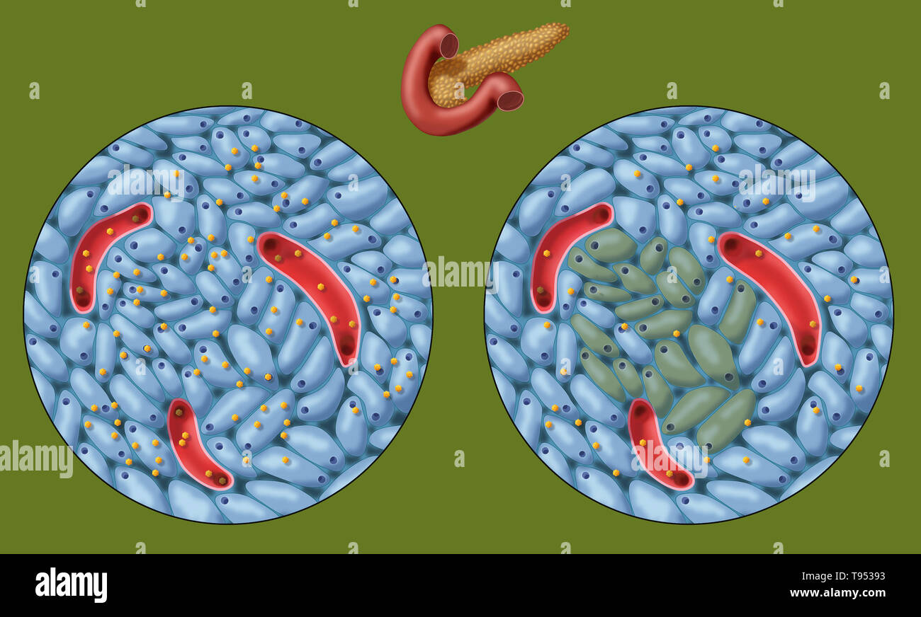 An illustration showing normal (left) and damaged insulin-producing ...