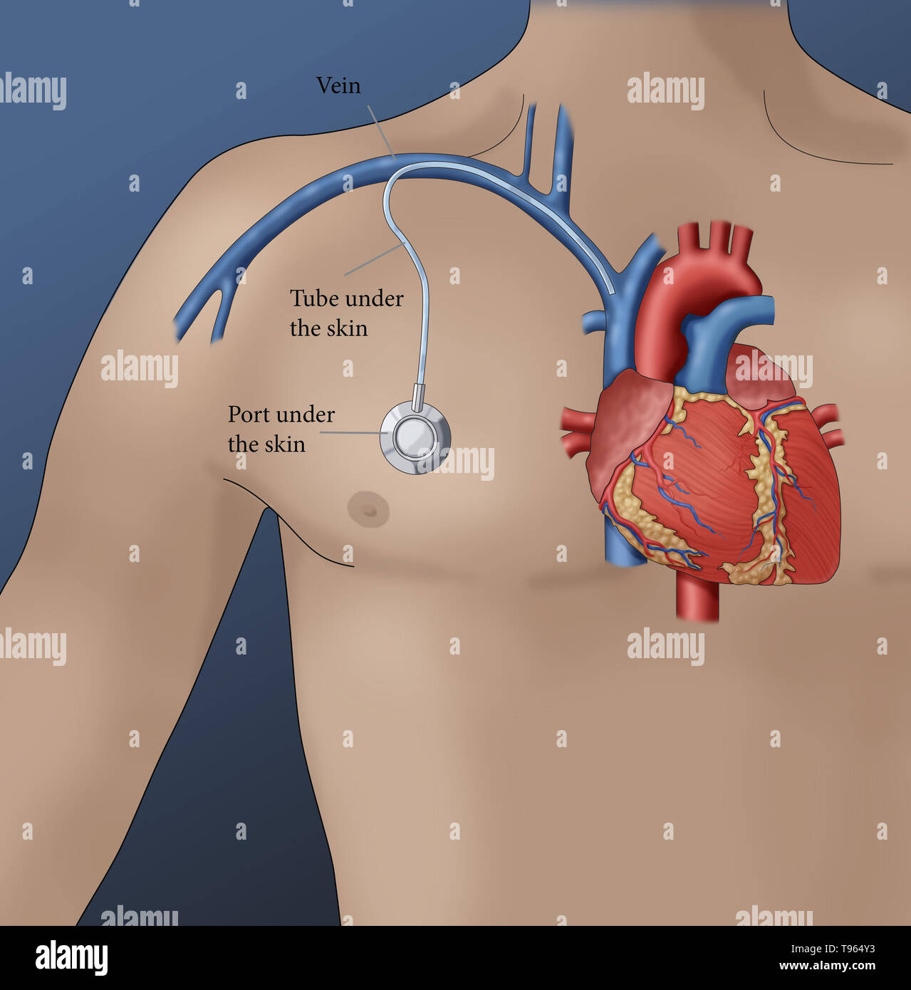 Illustration showing a venous access port, a small medical appliance ...