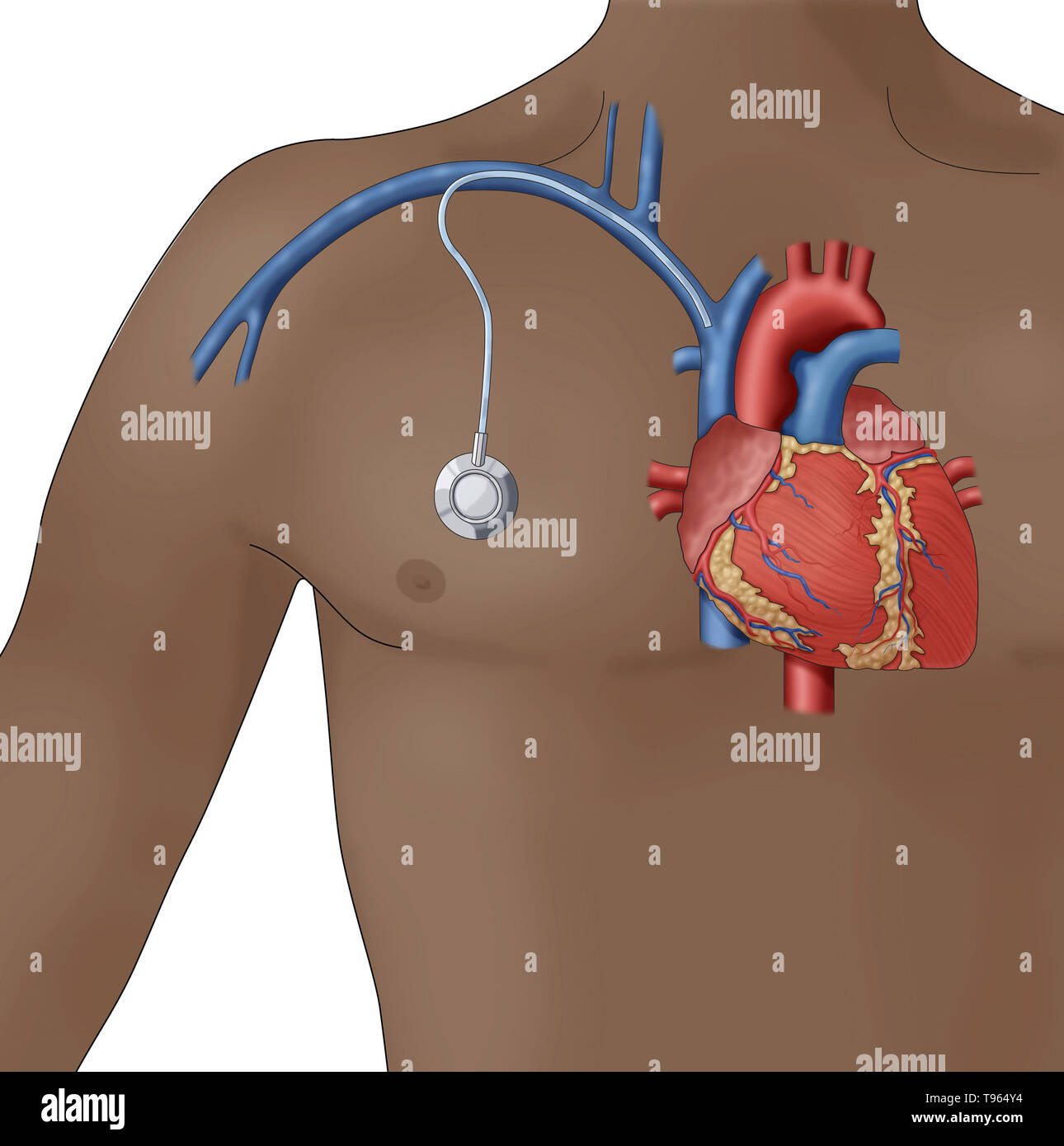 Port-A-Cath 101: How To Access The Port, 58% OFF