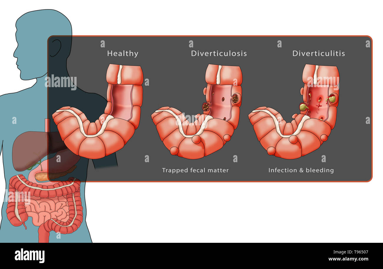 Illustration comparing the appearance of a healthy colon (left ...