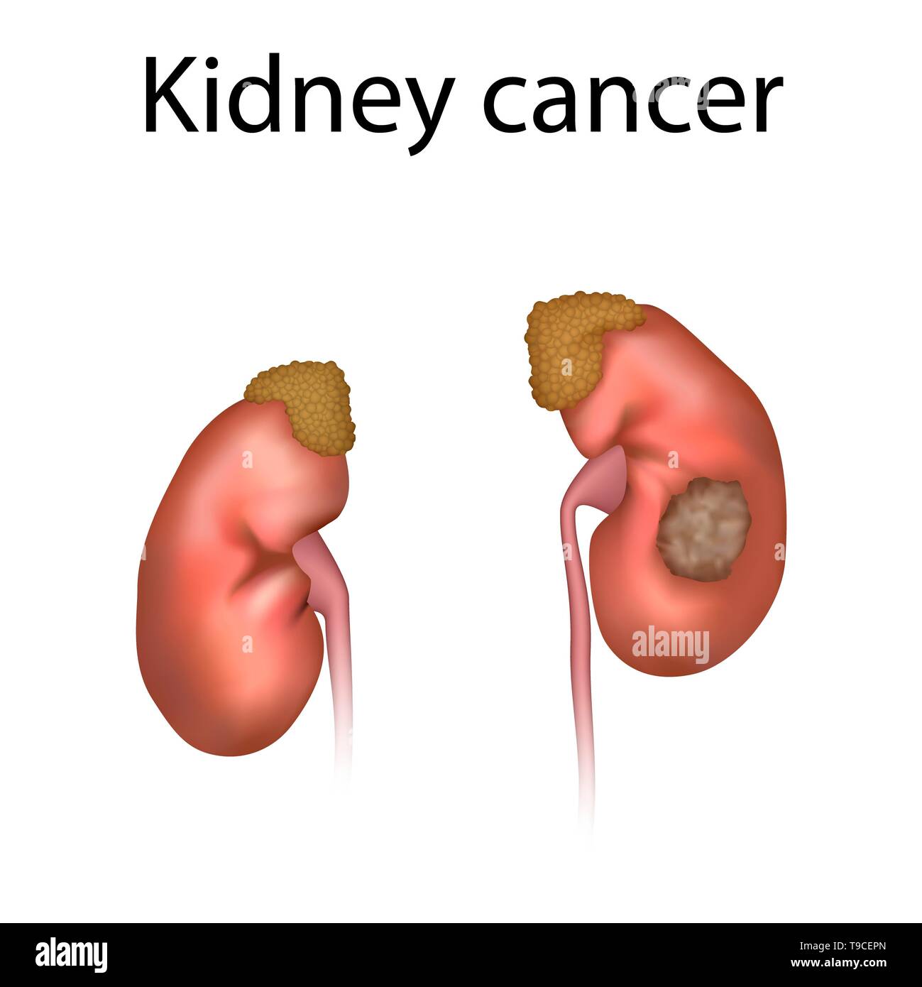 Kidney cancer, illustration Stock Photo - Alamy