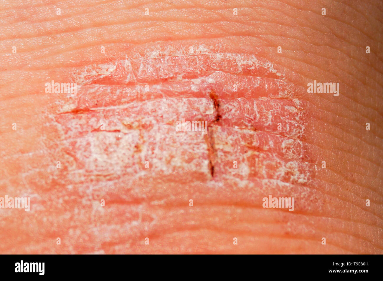 Psoriasis dry red and white irritation on the skin closeup. Image for ...