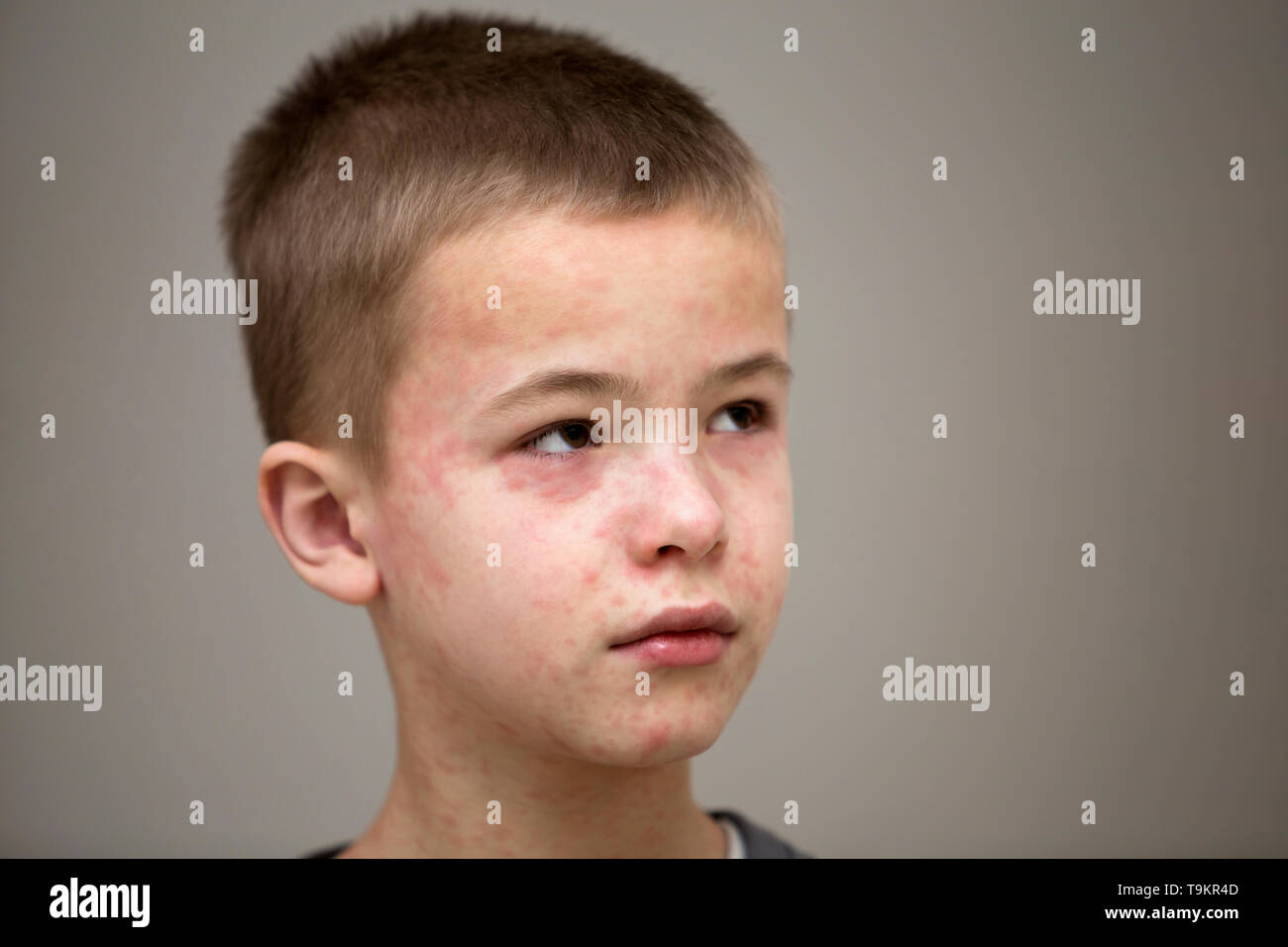 Portrait of sick sad boy child suffering from measles or chicken pox ...