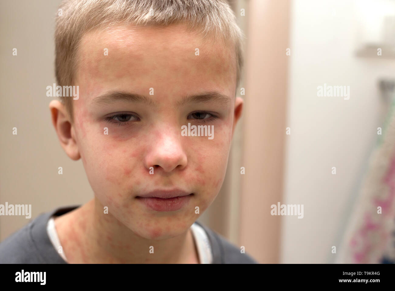 Portrait of sick sad boy child suffering from measles or chicken pox ...