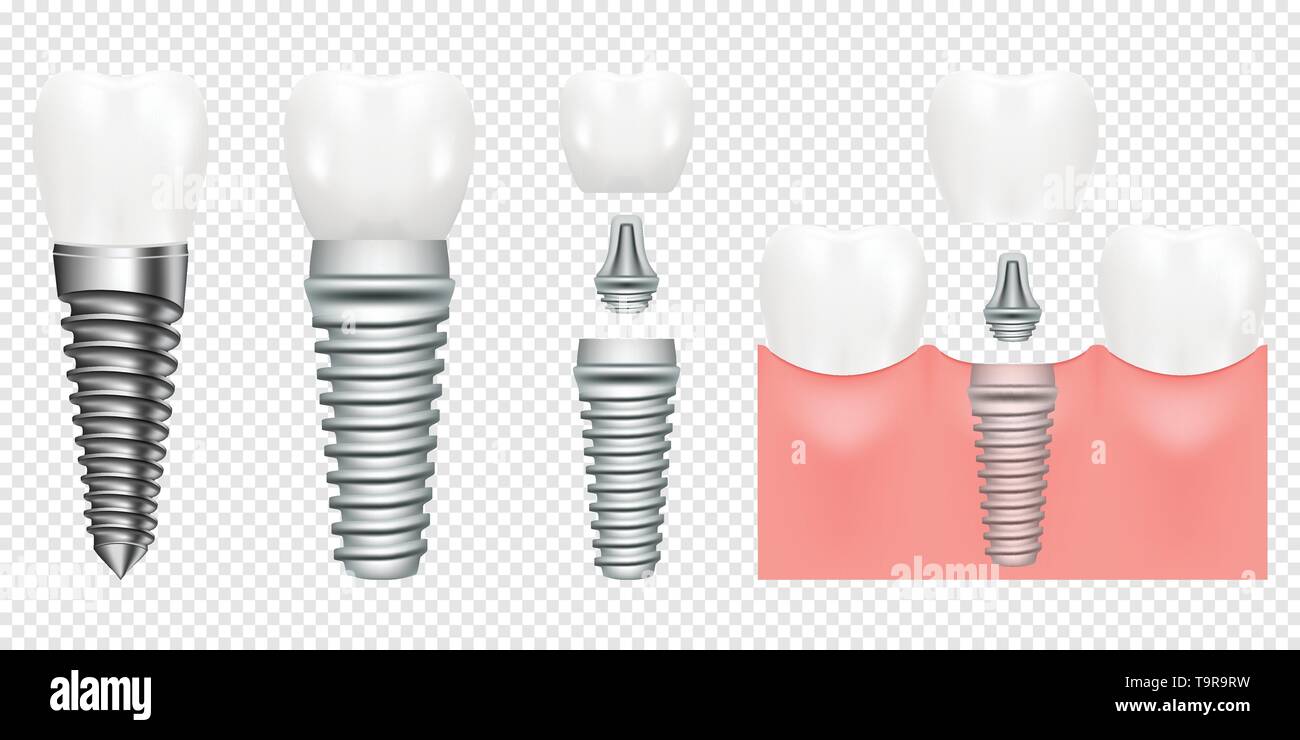 Human teeth and dental implant cut scheme, vector illustration. Dental ...