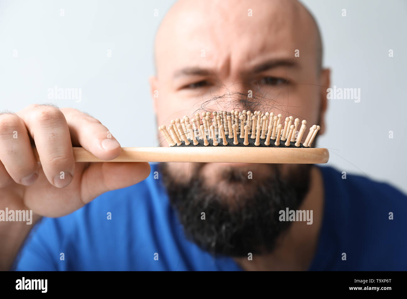 Man with hair loss problem on light background Stock Photo - Alamy