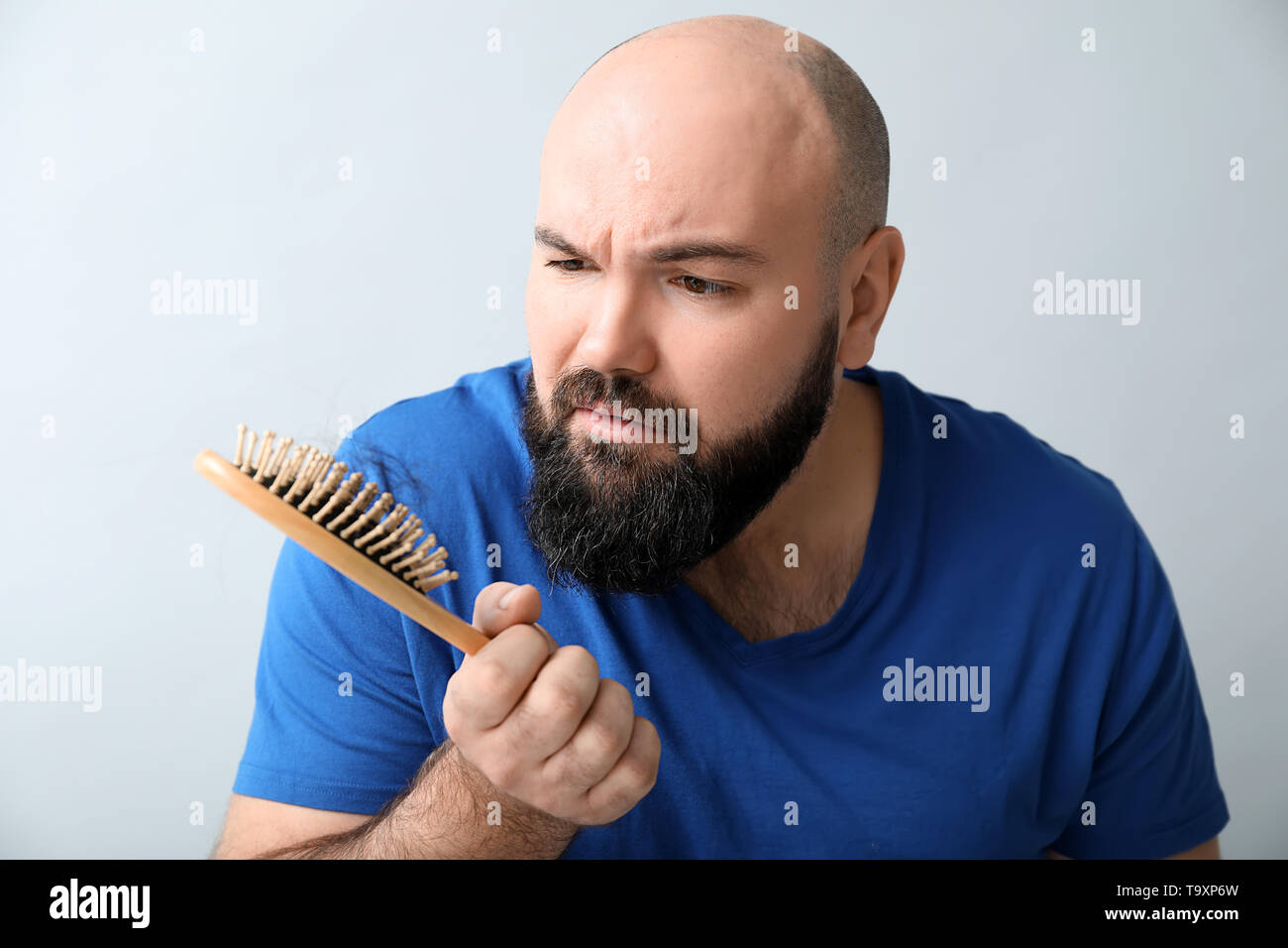 Man with hair loss problem on light background Stock Photo - Alamy