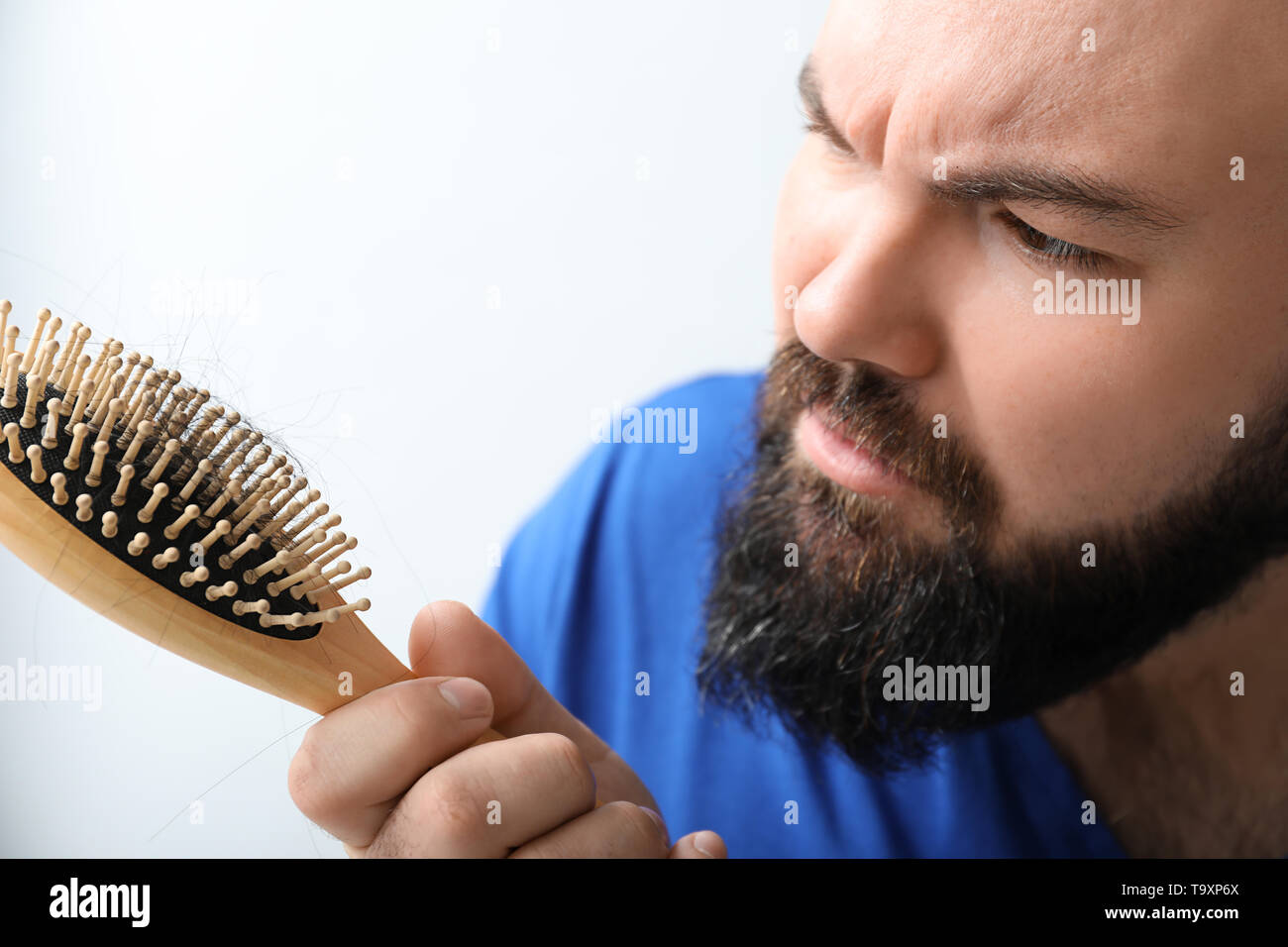 Man with hair loss problem on light background, closeup Stock Photo - Alamy