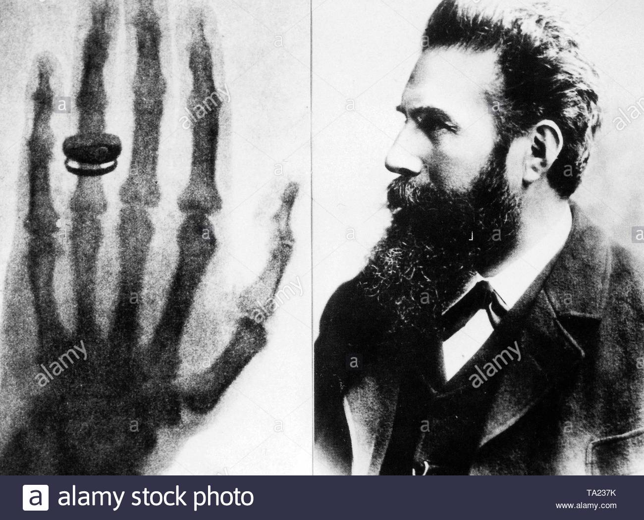 First X Ray Hand Stock Photos & First X Ray Hand Stock Images - Alamy