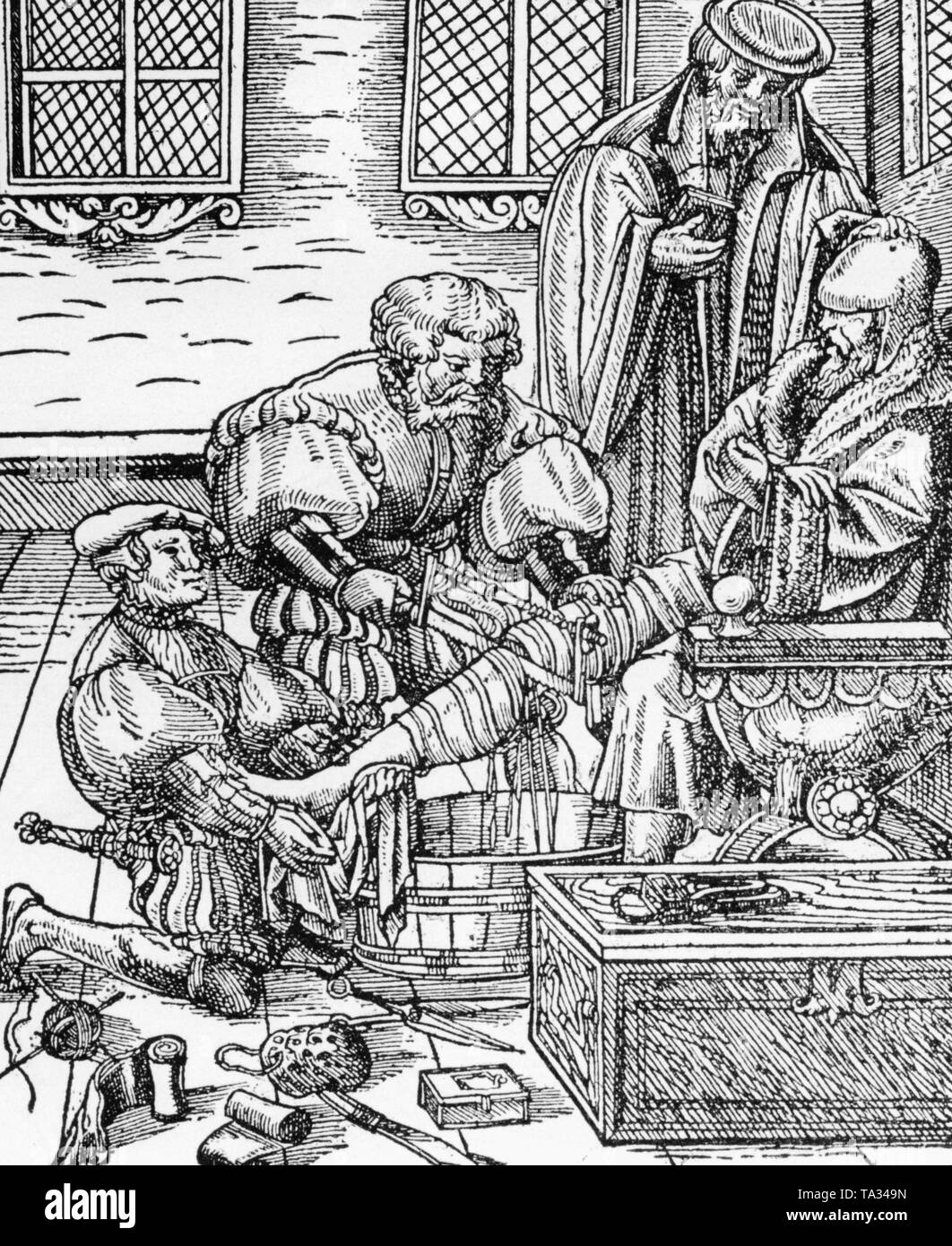 Amputation of a leg in the 15th century Stock Photo - Alamy
