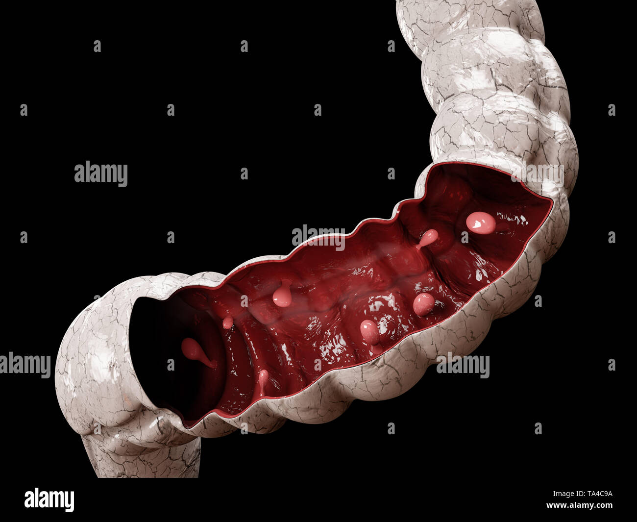 Human Colon Polyp High Resolution Stock Photography and Images - Alamy
