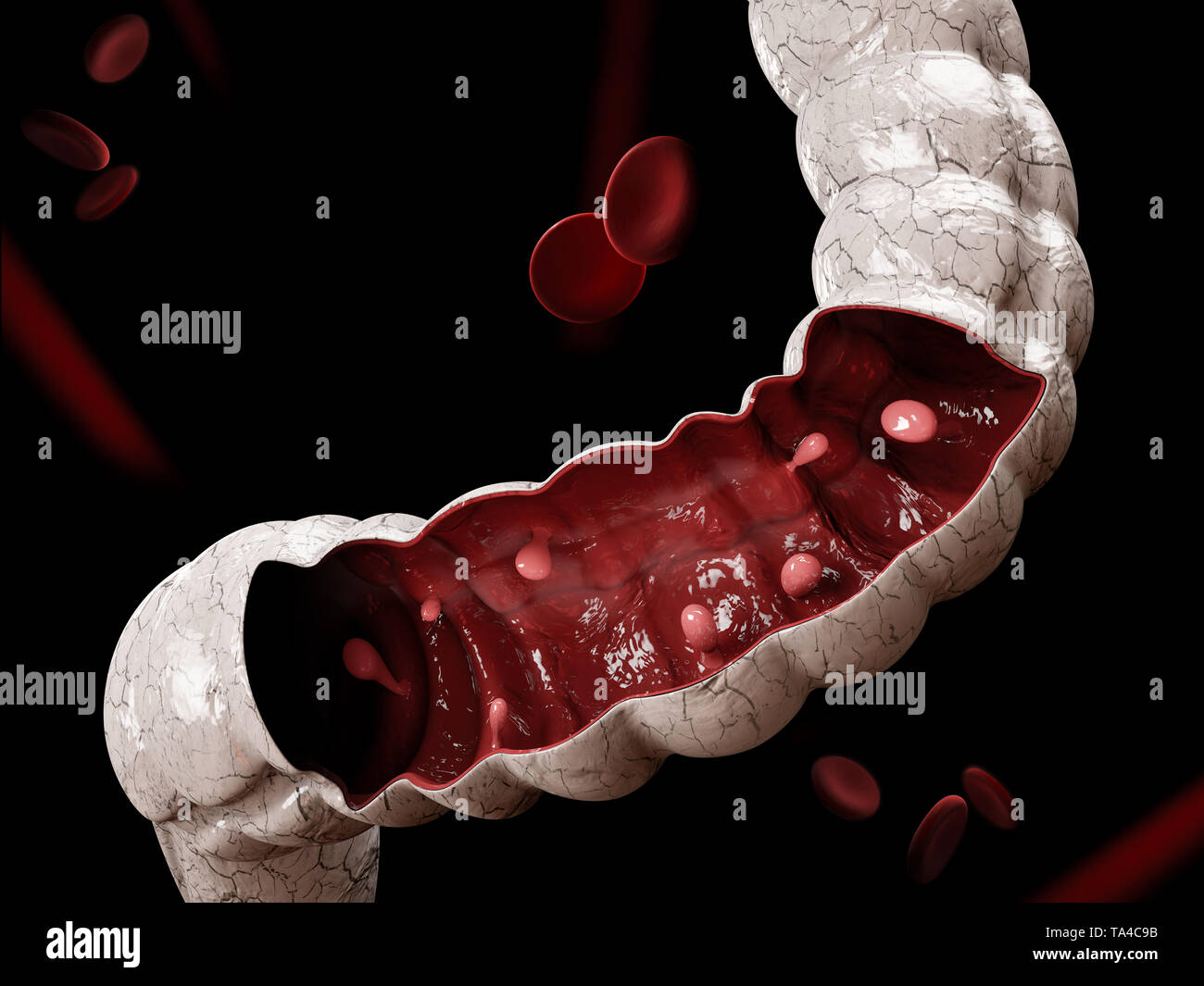 Polyp in the human colon hi-res stock photography and images - Alamy