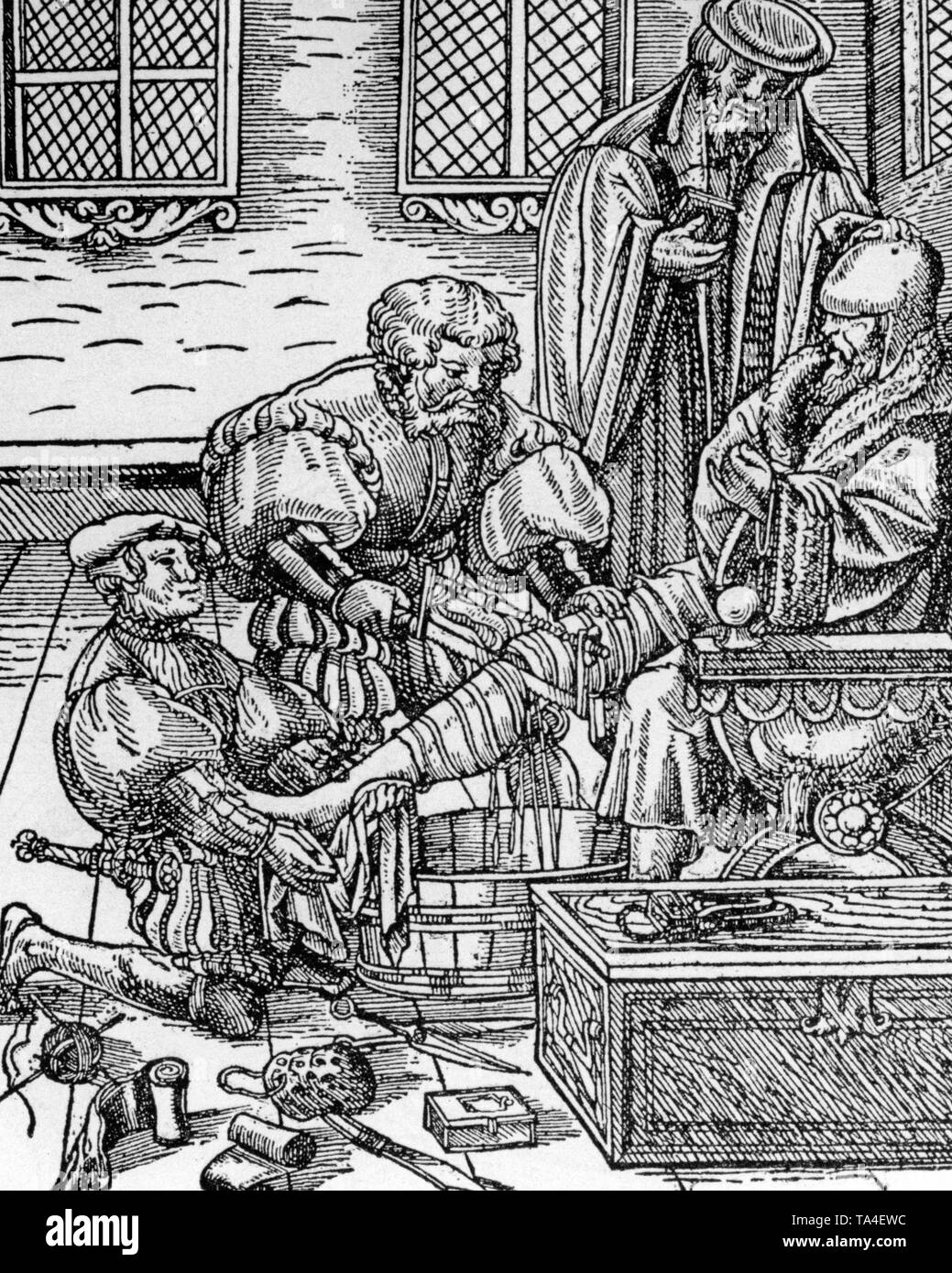 Drawing of a leg amputation. Tapes were used to stanch the blood and to ...