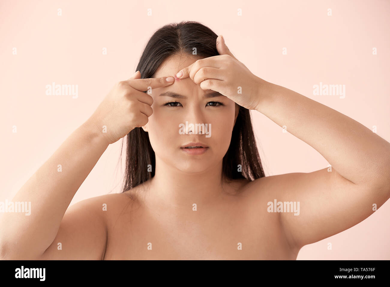 Portrait Of Young Asian Woman With Acne Problem Squishing Pimples On