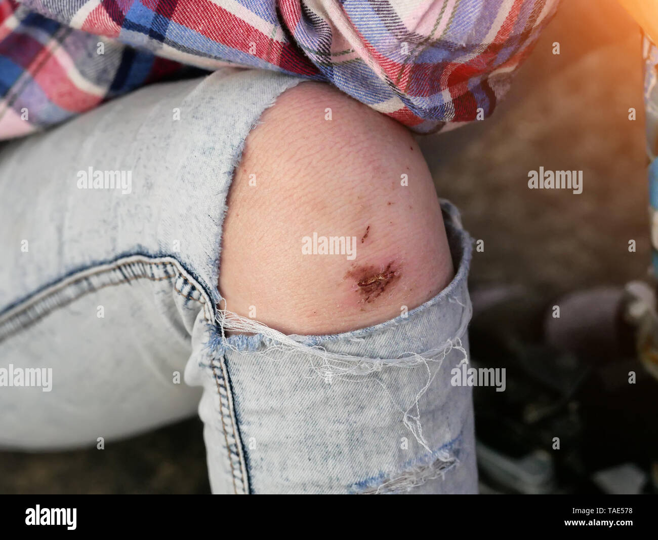 Broken knee hi-res stock photography and images - Alamy