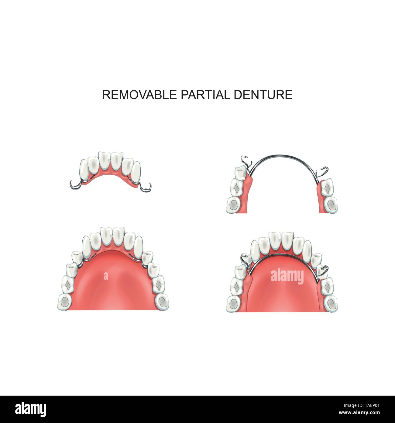 vector illustration of removable partial denture. prosthetics Stock ...
