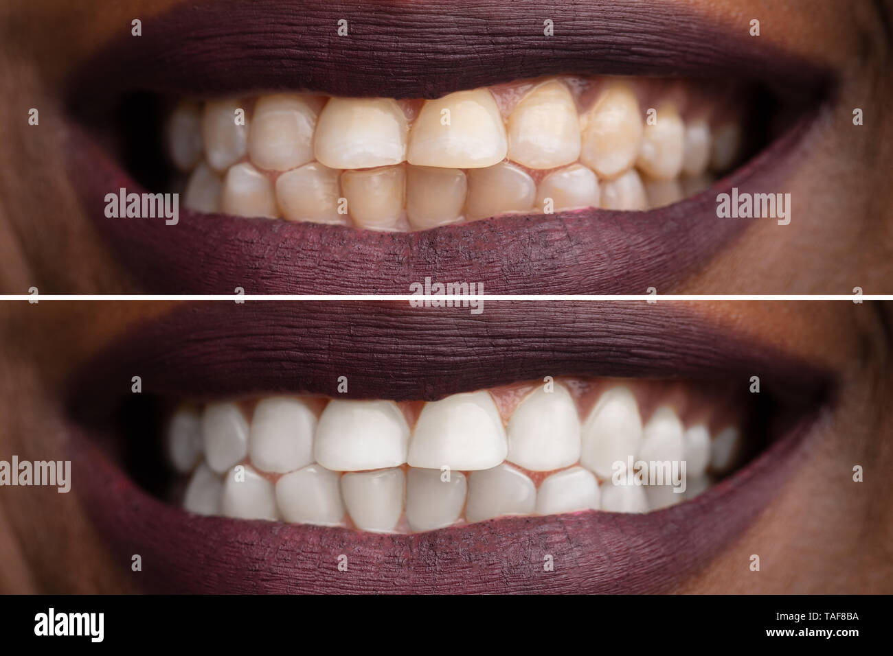 Skin bleaching before after hi-res stock photography and images - Alamy