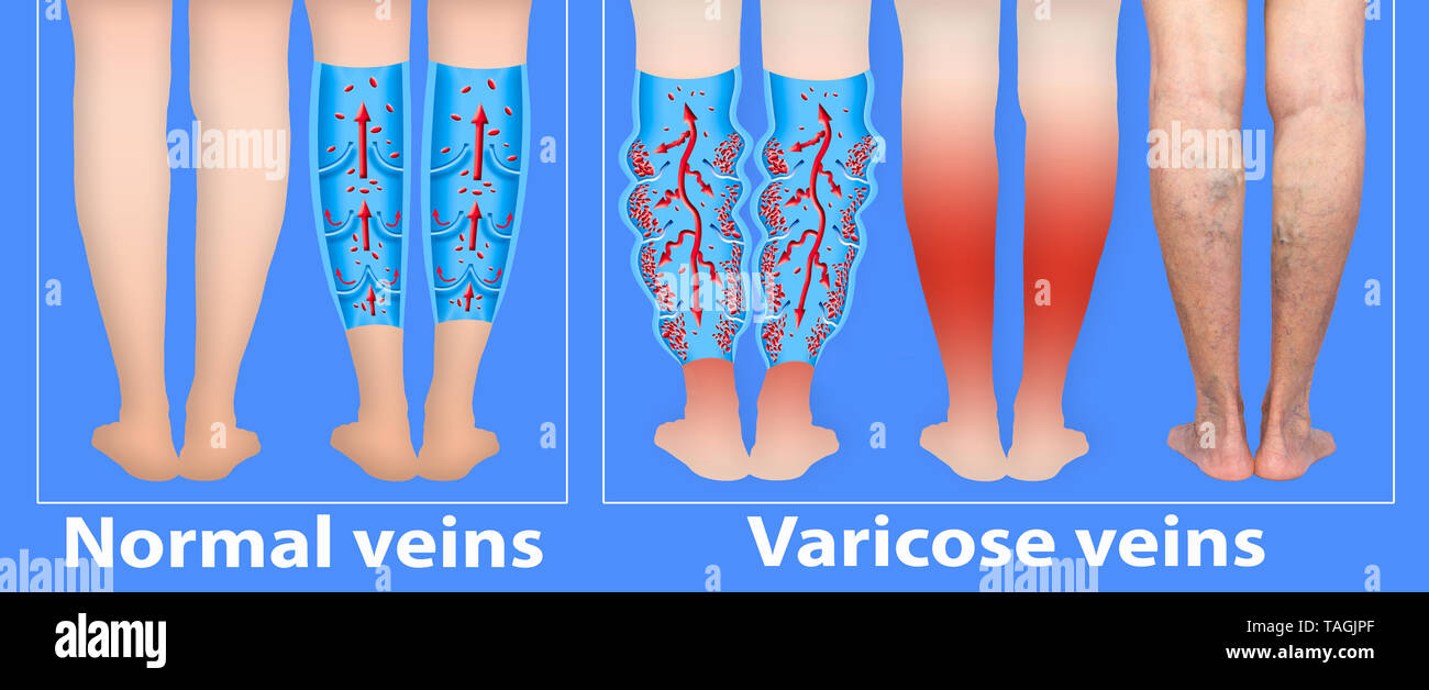 Varicose veins on a female senior legs. The structure of normal and ...