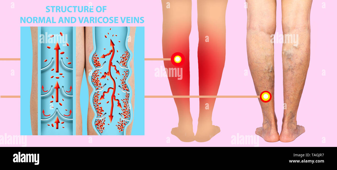 Varicose veins on a female senior legs. The structure of normal and ...