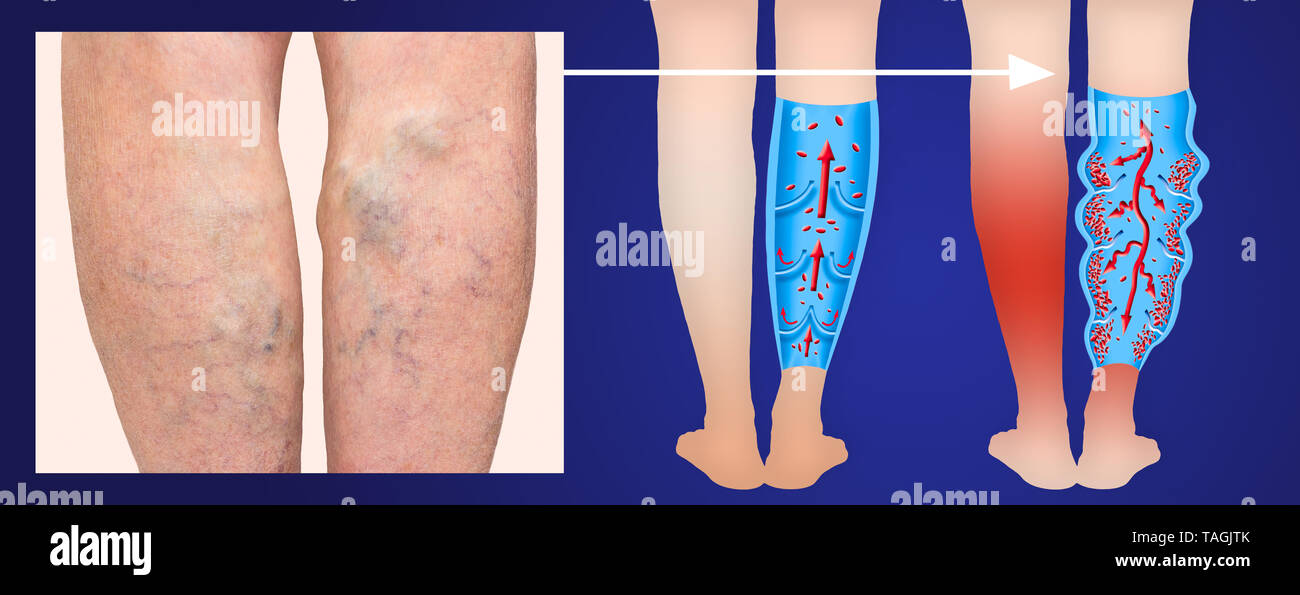 Varicose veins on a female senior legs. The structure of normal and ...
