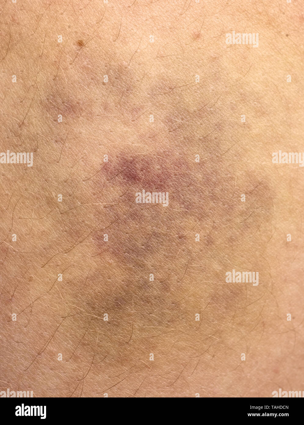 Skin bruise texture hi-res stock photography and images - Alamy