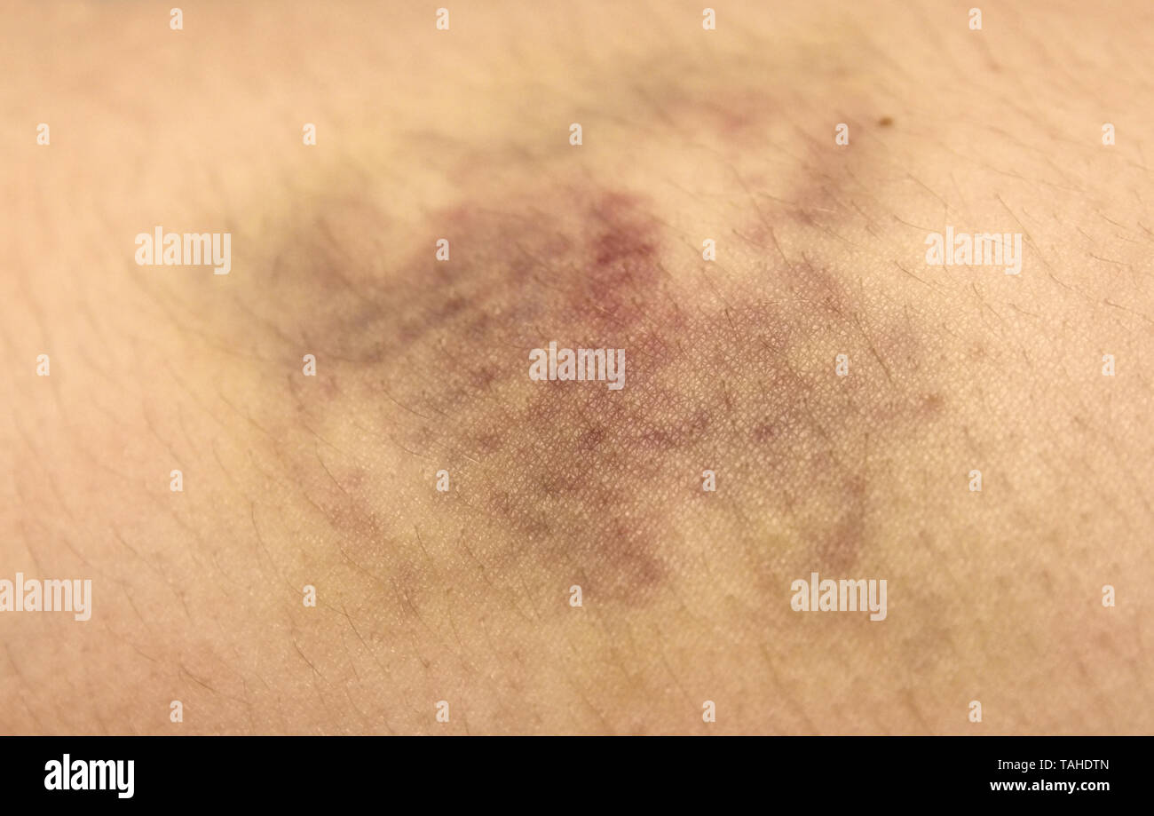 Scratch and bruise hi-res stock photography and images - Alamy