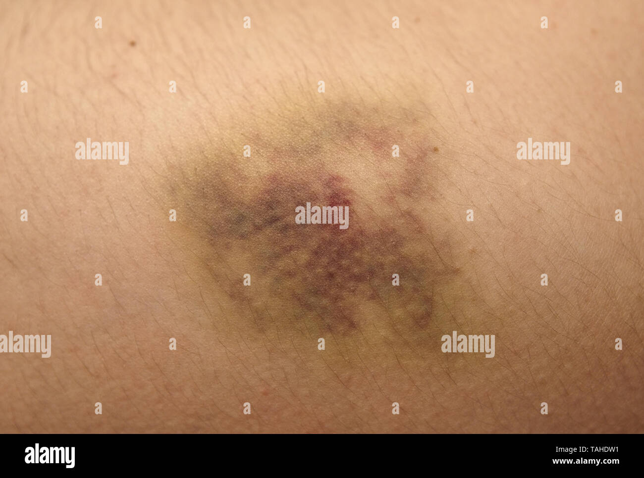 Skin bruise texture hi-res stock photography and images - Alamy