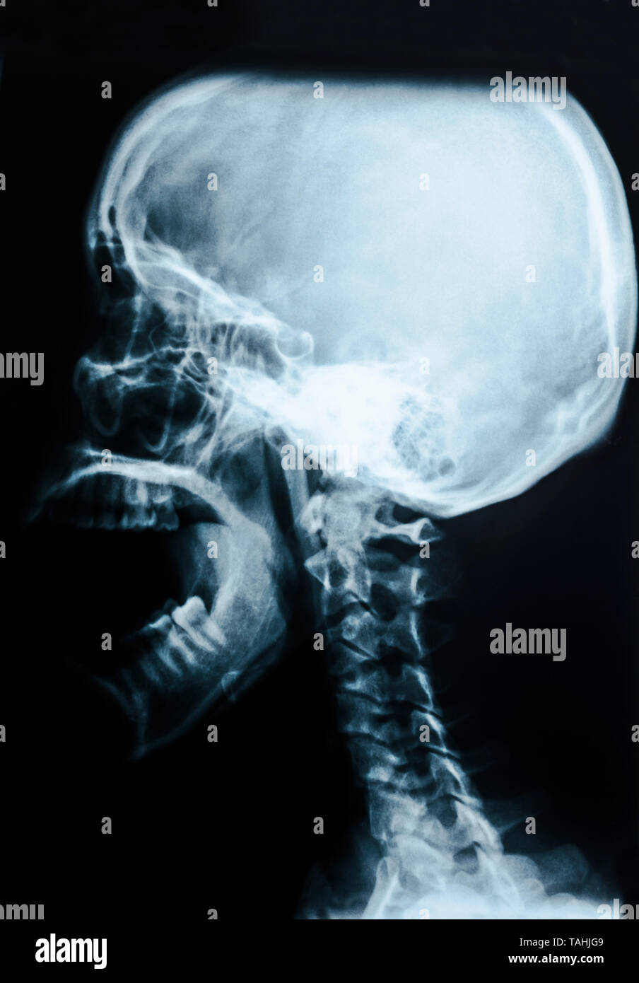 Film x-ray skull and cervical spine lateral view Stock Photo - Alamy