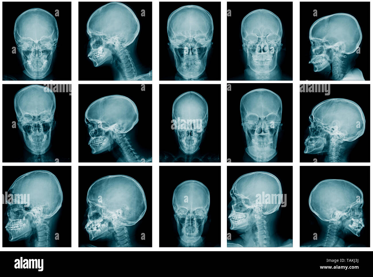 Front skull x ray image hi-res stock photography and images - Alamy