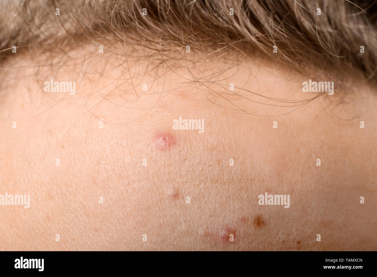 Acne problem hi-res stock photography and images - Alamy