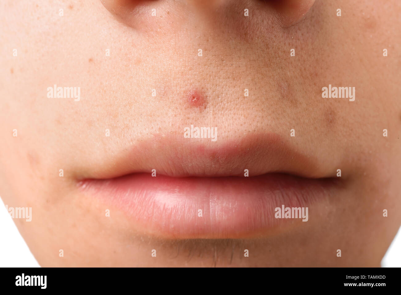 Teenager with acne problem, closeup Stock Photo - Alamy