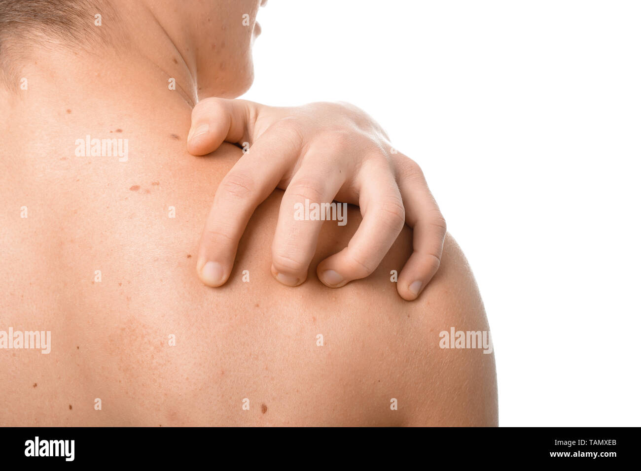 Teenager with acne problem on white background, closeup Stock Photo - Alamy