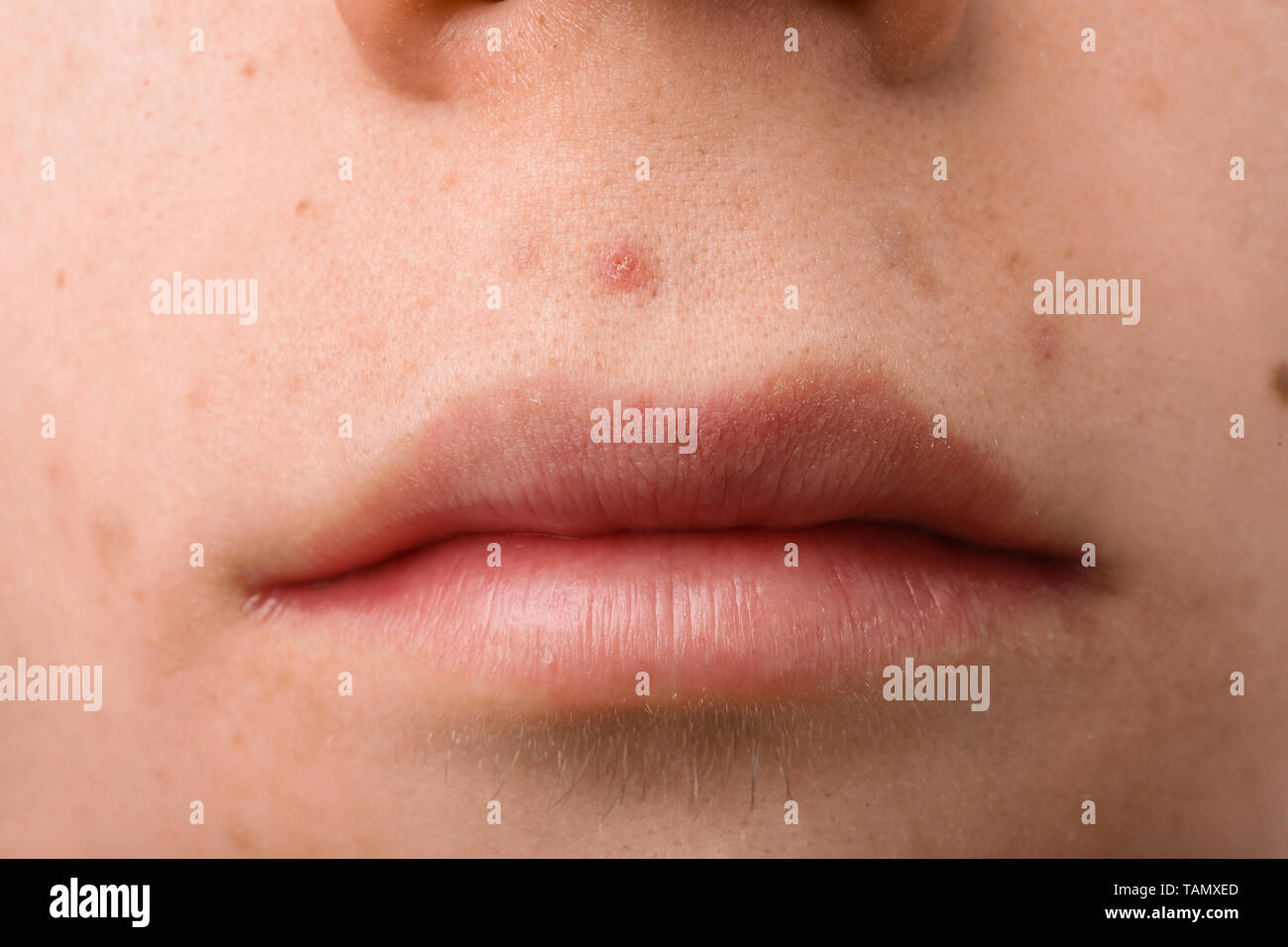 Teenager with acne problem, closeup Stock Photo - Alamy