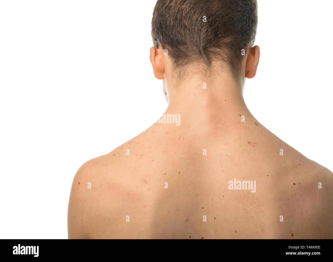 Teenager with acne problem on white background Stock Photo - Alamy